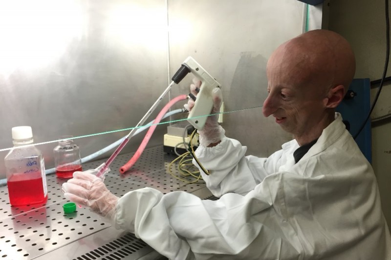 Sammy Basso: cos'è la progeria